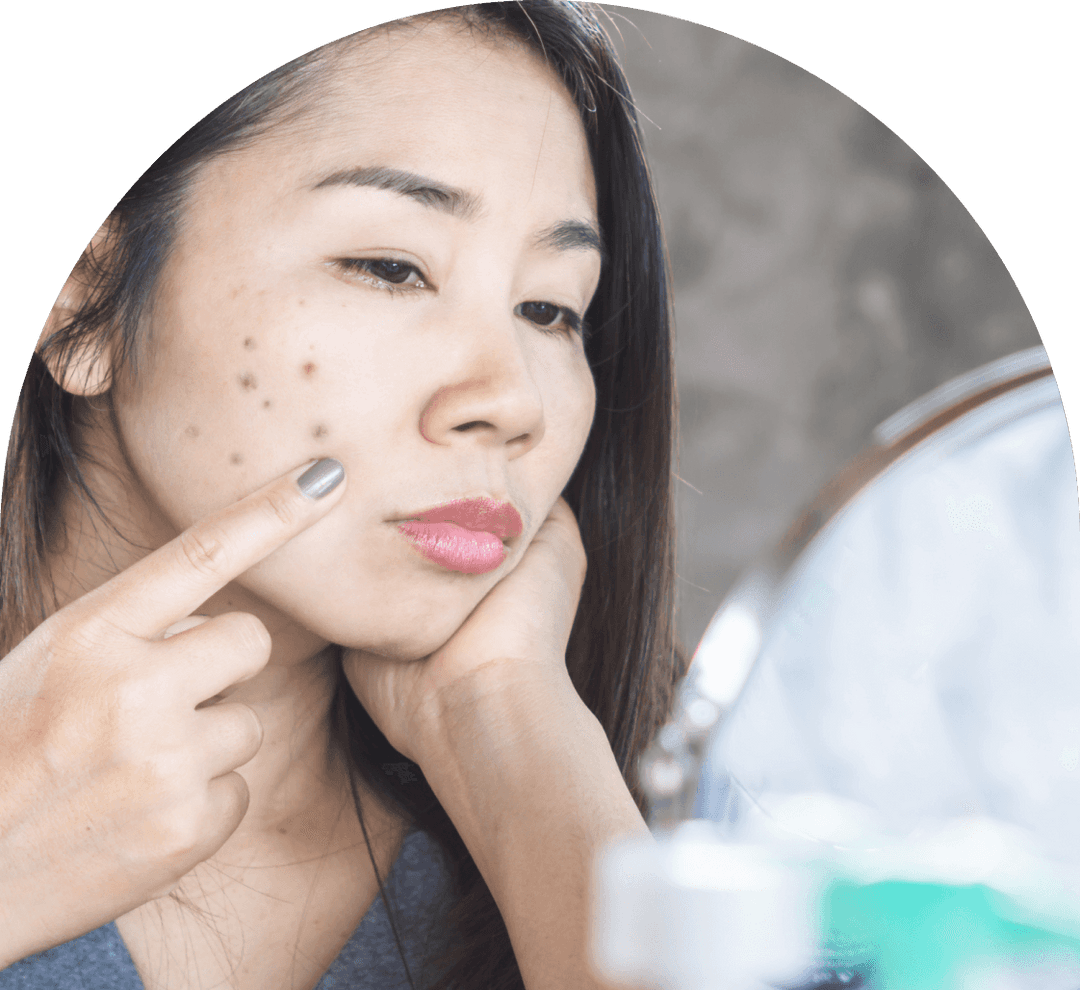 Solusi Mudah & Tepat Menghilangkan Masalah Bekas Jerawat - Diri Care