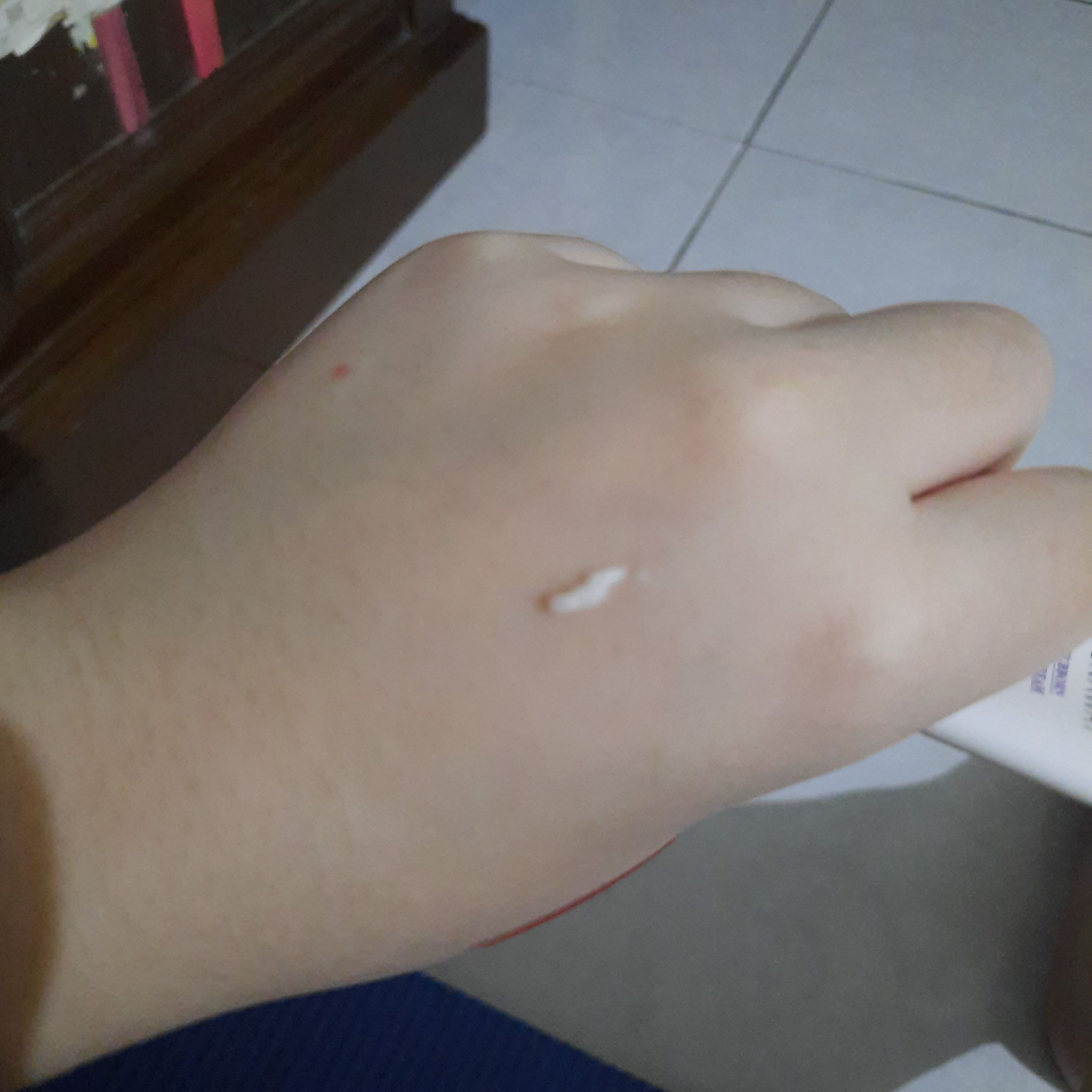 Acnaway Stubborn Acne Cream - Beauty Review