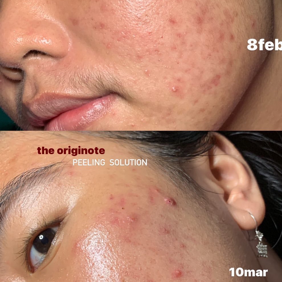 The Originote Peeling Solution - Beauty Review