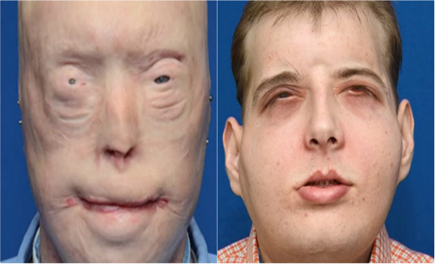 U.S. firefighter gets world's most extensive face transplant