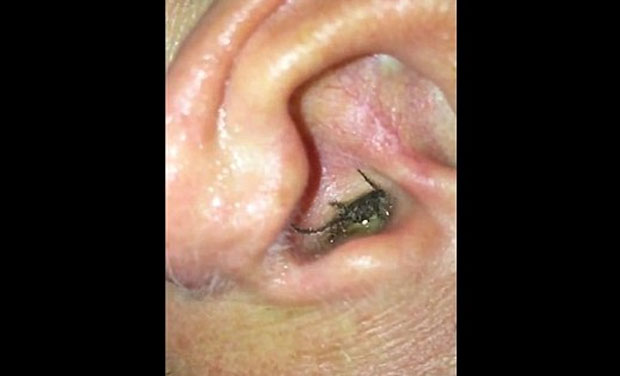 Watch: Man finds a huge spider hiding inside his ear