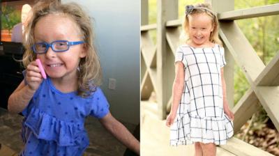 US girl sheds and grows skin daily due to rare condition