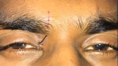 Accident at work leaves welder with 3 cm piece of metal hanging out of ...