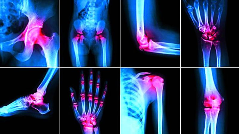 Identify arthritis symptoms