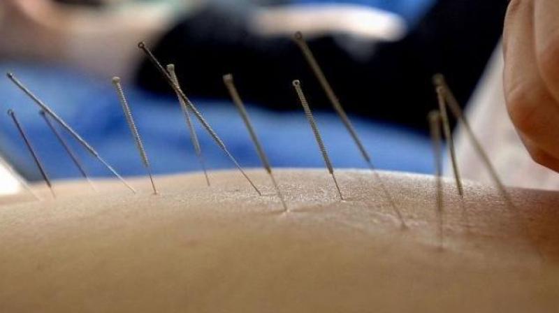 Doctors shocked to find needles buried inside woman's body for 30 years