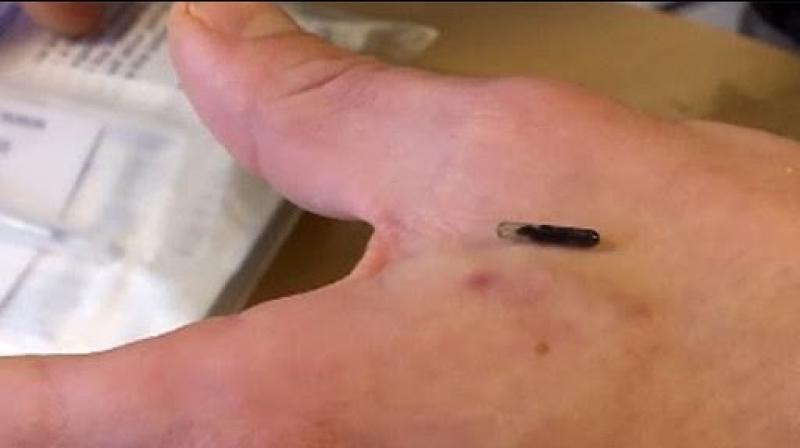 Man receives under-skin chip implant live at MWC2019