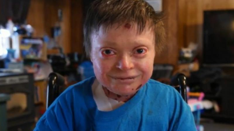 Boy without skin refuses life-saving treatment as he is afraid he won't ...